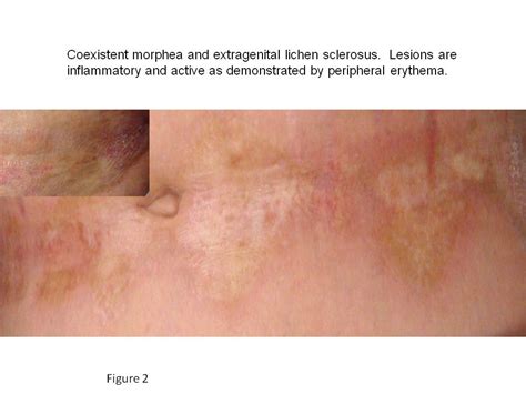 Localized Morphea