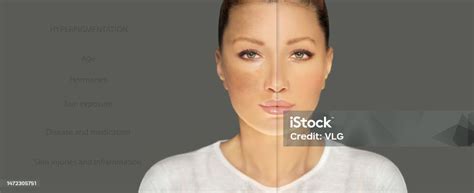 다크 스팟 주근깨 과색소 침착 개념 피부 미백 피부 미백 과일 산 Aha 피부 브라이트닝 45 49세에 대한 스톡 사진 및 기타 이미지 Istock