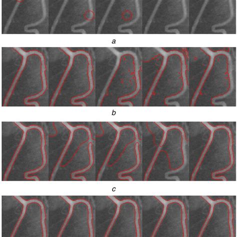 Segmentation Results Of Vessel Image With Different Initialcontours A