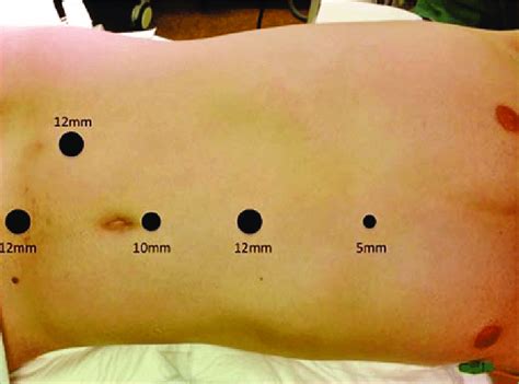 Picture Showing Port Placement For Laparoscopic Right Ileal Ureter 10 Download Scientific