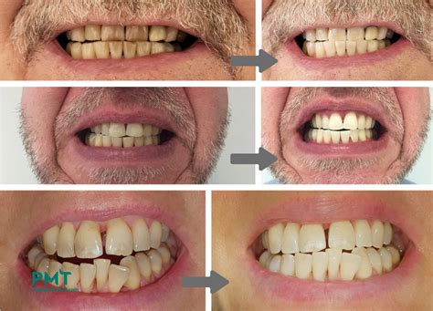 Teeth Whitening In Iran Teeth Bleaching In Iran Bleaching Teeth Cost Pars Med Travel