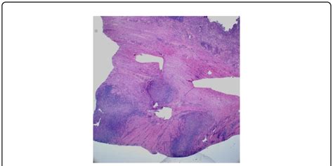 Histology From Surgical Specimen Showing Inflammation And Abscess Download Scientific Diagram