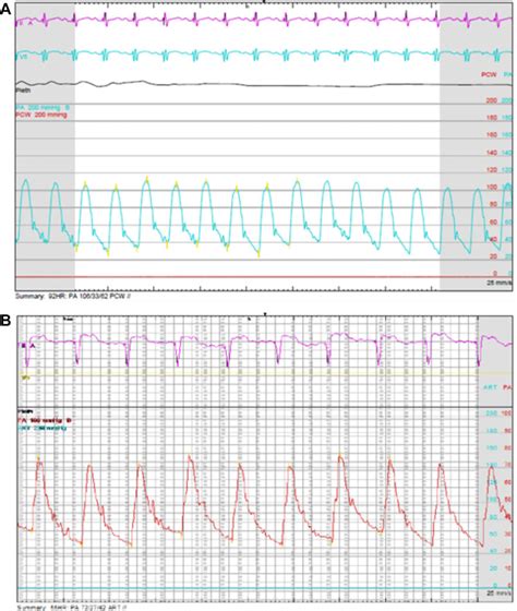 Invasive Hemodynamics Download Scientific Diagram