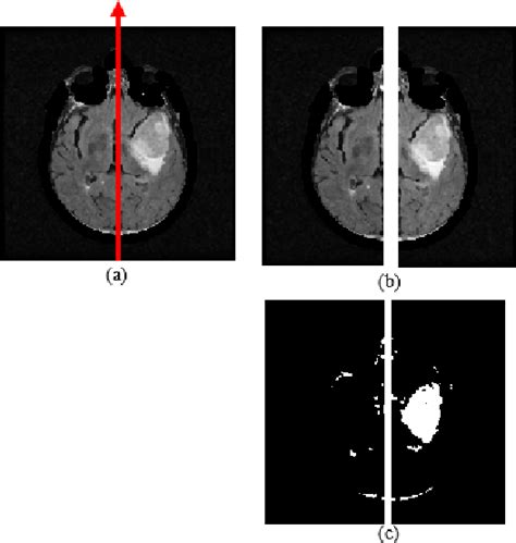 Figure 6 From Automatic Brain Tumor Detection And Volume Estimation In Multimodal Mri Scans Via