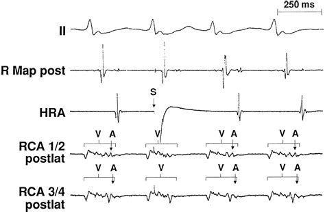 Radiofrequency Current Catheter Ablation Of Accessory Atrioventricular Pathways In Ebsteins