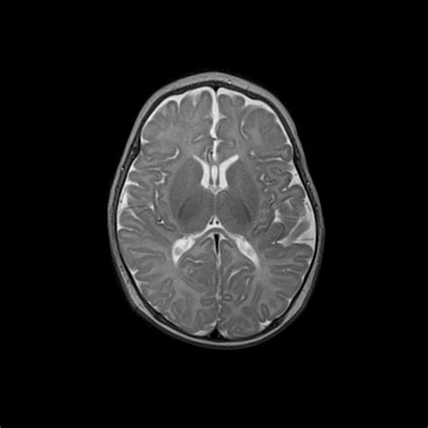 Normal Myelination Pacs
