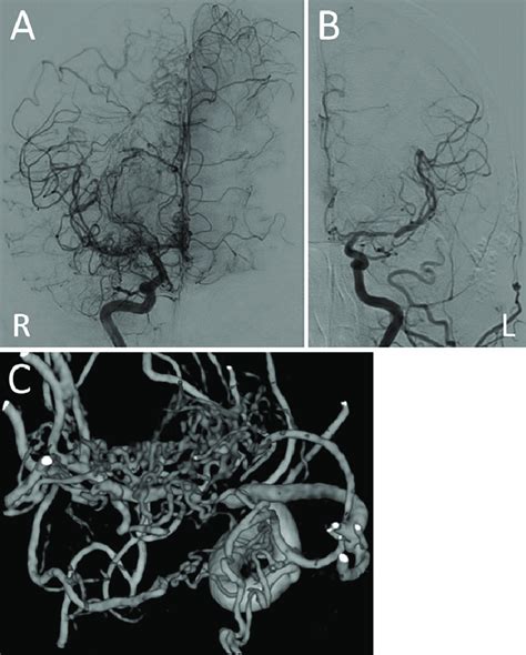 Dsa Showing Occlusion Of The Right M1 Segment Associated With Plexiform Download Scientific