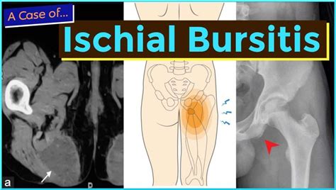 Ischial Bursitis Meded Cases