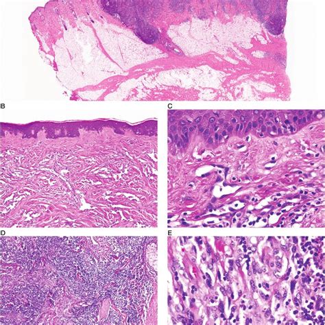 Pdf Index Report Of Cutaneous Angiosarcoma With Strong Positivity For