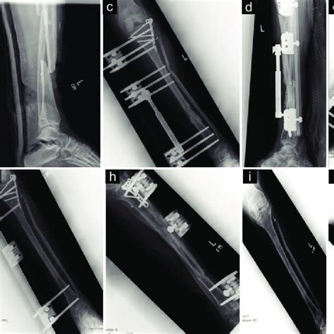 A Anteroposterior View Of An Open And Displaced Tibia Shaft Fracture Download Scientific