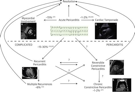 Complicated Pericarditis Understanding Risk Factors And