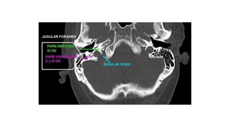 Anatomy And Imaging Of Cranial Nerves Pptx