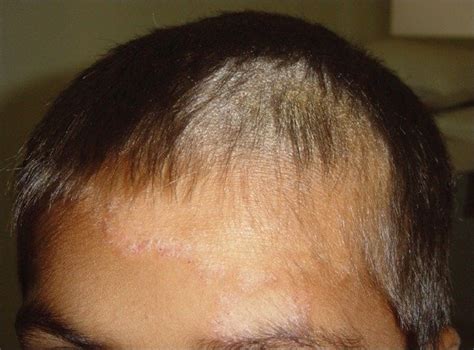 Tinea Capitis Ectothrix