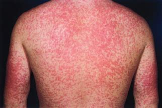 Rash Drug Eruptions Anesthesia Key