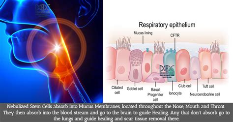 Nebulized Mesenchymal Stem Cell Treatment Dreambody Clinic