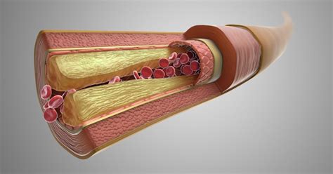 Hypernatremia Symptoms And Causes Kees
