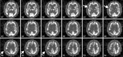 Tc 99m Ecd Spect At 1 Month After The Onset Of Cerebral Infarction Download Scientific Diagram