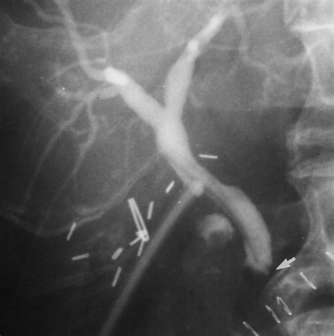 T Tube Cholangiogram