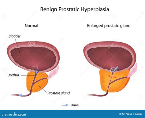Benign Prostatic Hyperplasia Bph Stock Vector Illustration Of