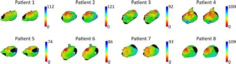 For Rotor Arrhythmia We Achieved Activation Time Accuracy Of