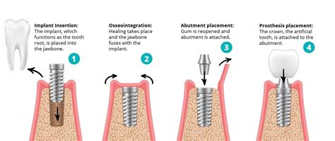 Dental Implant Placement Steps At Jessica Bullard Blog