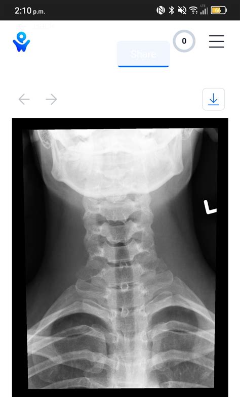 Displaced Or Nondisplaced Toe Fracture Revised W 3 Views R Xrays