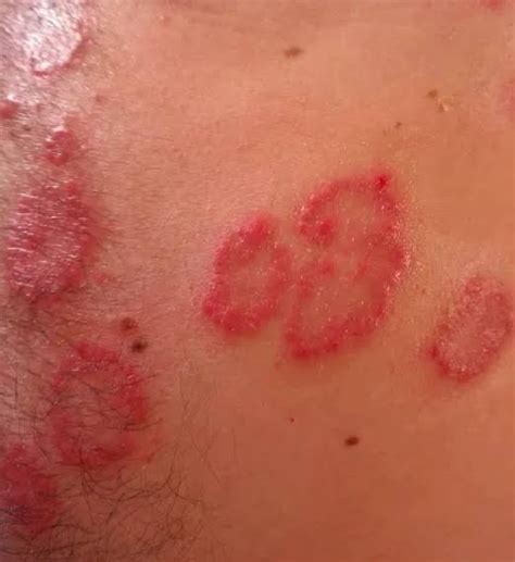 Fungal Infections Causes Symptoms And Treatment Simplexplainer