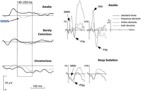 Mismatch Negativity Mmn And P300 In Anesthesia A Mmn Elicited At Download Scientific