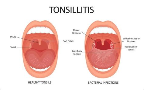 Tonsillitis Treatment With Herbal Remedies