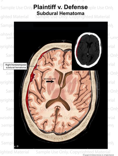 Subdural Hematoma