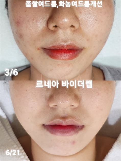창원 상남동 피부관리실 성인 여드름 좁쌀여드름 흉터자국 개선사례20대 여성 네이버 블로그