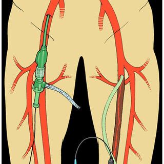 Diagram Of Total Percutaneous Bypass Showing Introduction Of The Stiff Download Scientific