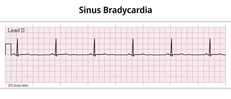 Bradycardia Acls Algorithm Safety Training Seminars