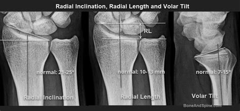 Anatomy Of Distal Radius Surfaces Landmarks And Clinical Relevance