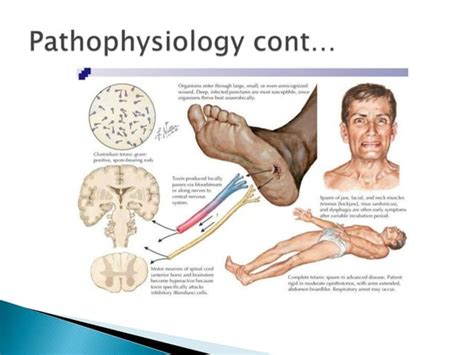 Tetanus Prophylaxis And Types Of Immunitynewnewv Pptx Infectious Diseases Diseases And