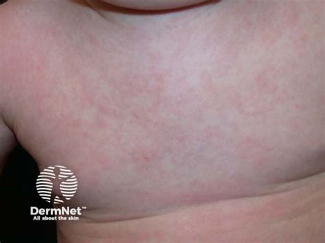 Roseola Symptoms