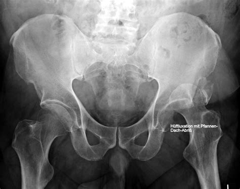 Dislocation Of Hip Joint Doccheck