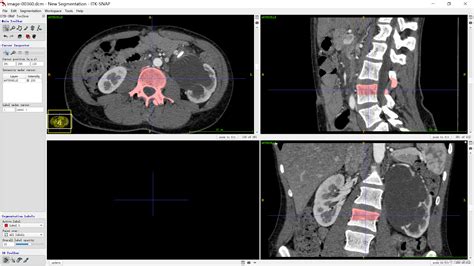 Itk Snap的学习（二）感兴趣区域的勾画 Csdn博客