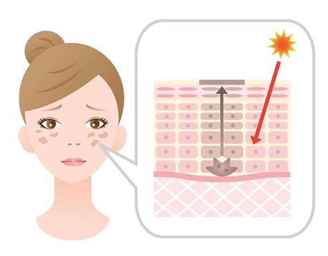 Skin Pigmentation Singapore Types And Treatments Sl Aesthetic