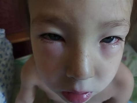 Чем лечить ребёнка Чем можно капать глазки малышу 3 мес при коньюктивите Medaboutme