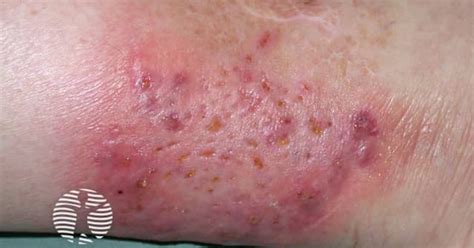 Pyoderma Gangrenosum Image