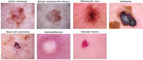 Enhancing Melanoma Skin Cancer Detection Through Feature Fusion Of Pre Trained Deep