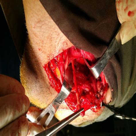 Intraoperative View After Cutting The Styloid Process Download