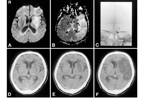 Case 13 Group 2 Diffusion Weighted Image Taken 6 Hours After The