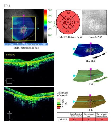 Optical Coherence Tomography Oct Macular Cube 512 × 128 Scan