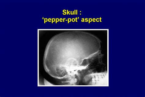 Parathyroid6 Clip Image004 0000 Endotext