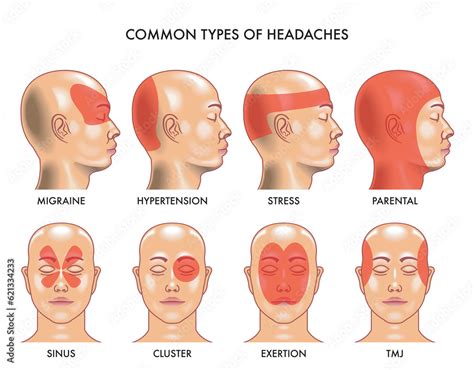 Medical Illustration Of Common Types Of Headaches Stock Illustration Adobe Stock