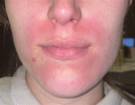 Alcohol Poisoning Rash
