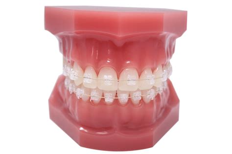 Roth 022 Equation Self Ligating Aesthetic Bracket Young Specialties