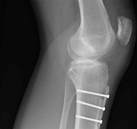 What Is A Kneecap Dislocation Knee Cap Surgeon London Expert Knee